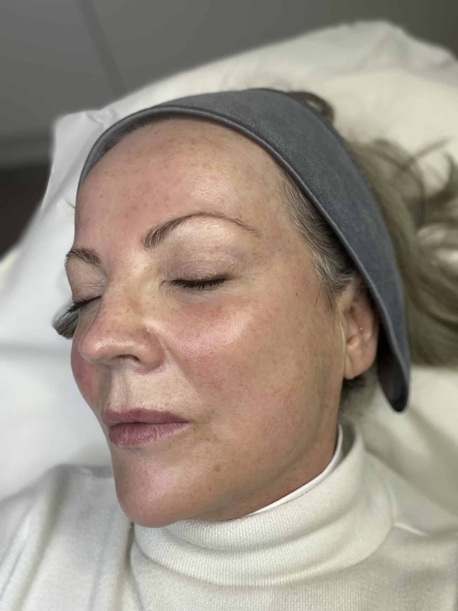 Tailored Facial Treatments - FTT Skin Clinics